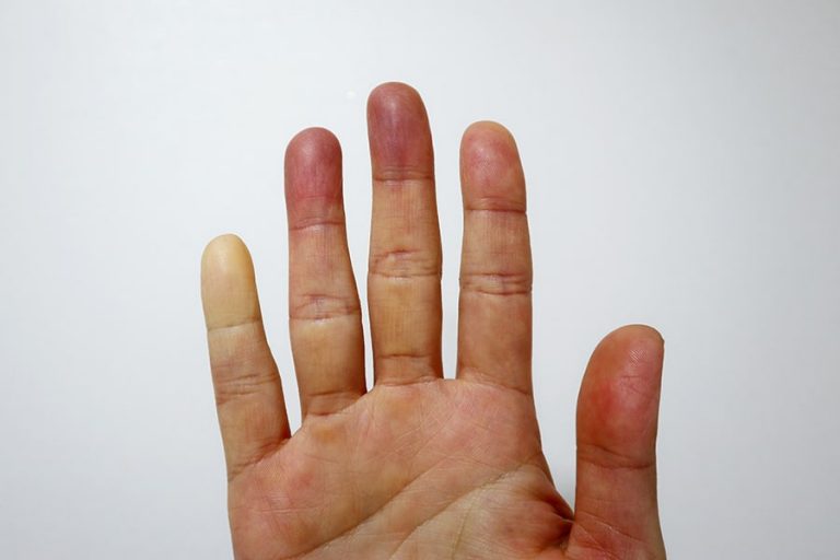 Raynaud’s disease - what it is and how to cope - Rest Less