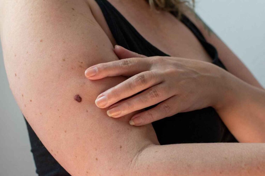 Melanoma skin cancer – 5 skin changes you shouldn’t ignore - Rest Less